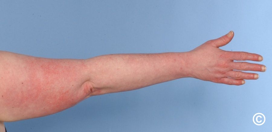 Dermatomyositis (and polymyositis)