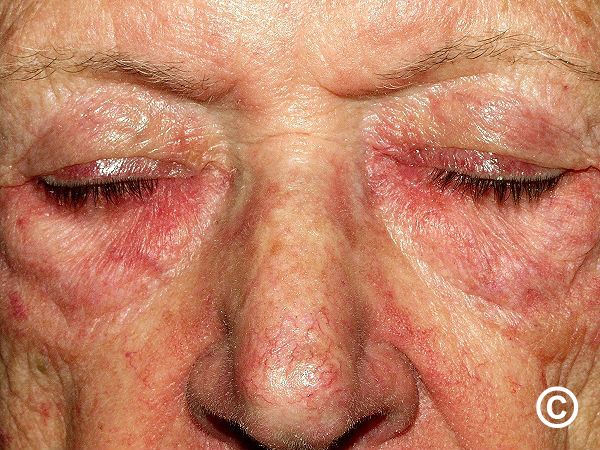 Dermatomyositis Face