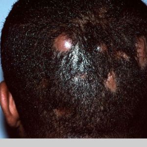 Dissecting Cellulitis