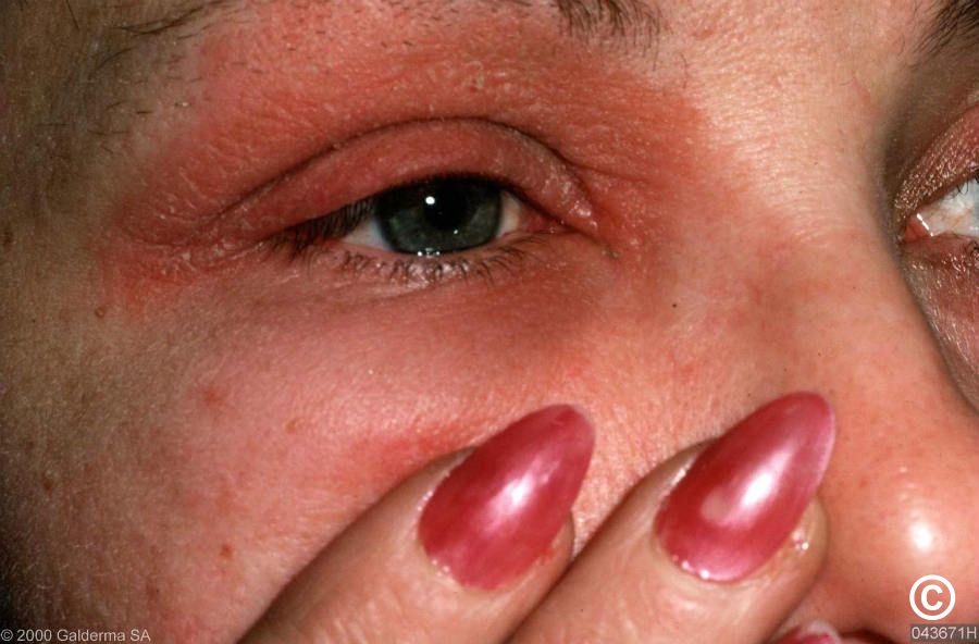 Photoallergic Contact Dermatitis Face