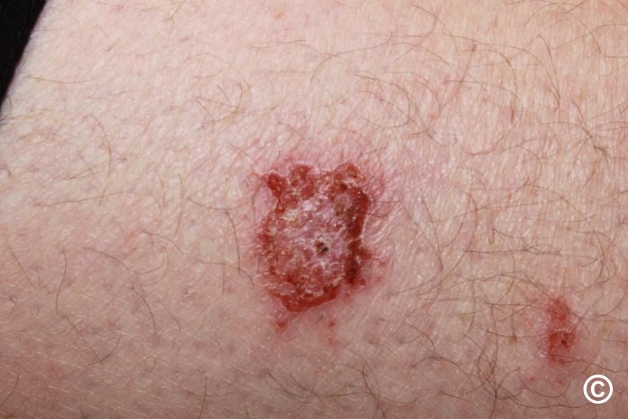 Nummular Eczema Baby