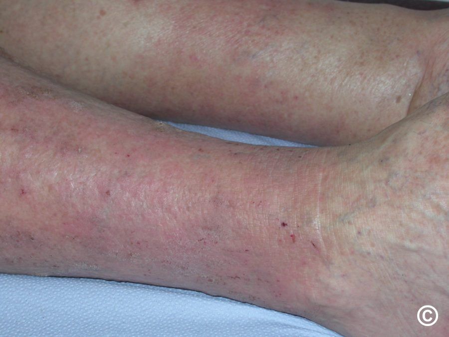Eczema Legs