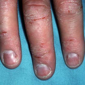 Mild Eczema Hands