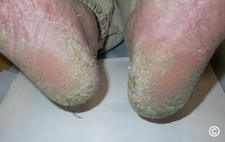 Eczema On Bottom Of Foot