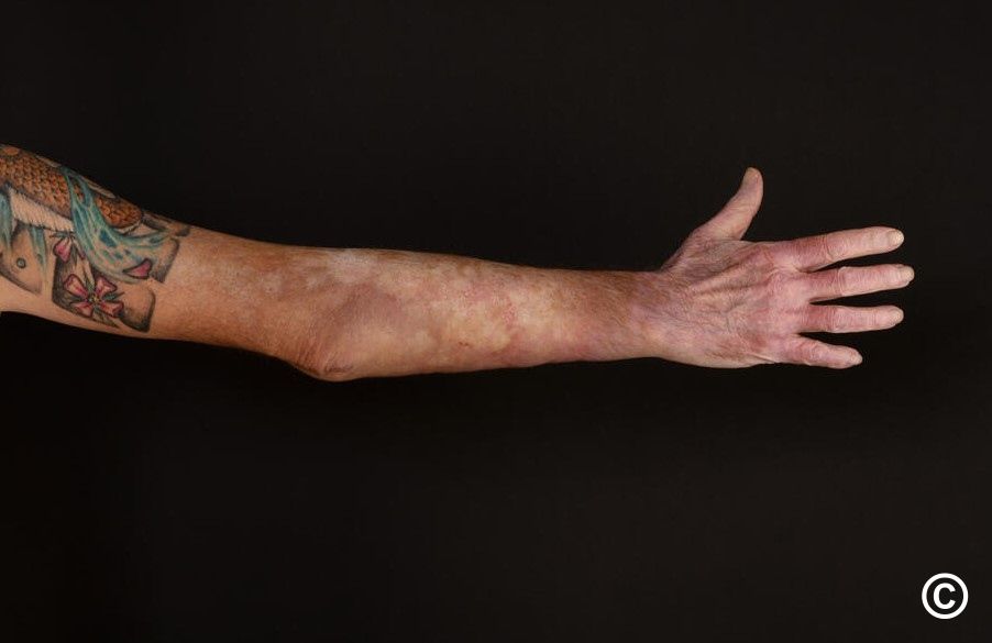 Eosinophilic Fasciitis Groove Sign