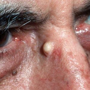 Infected Sebaceous Cyst Behind Ear