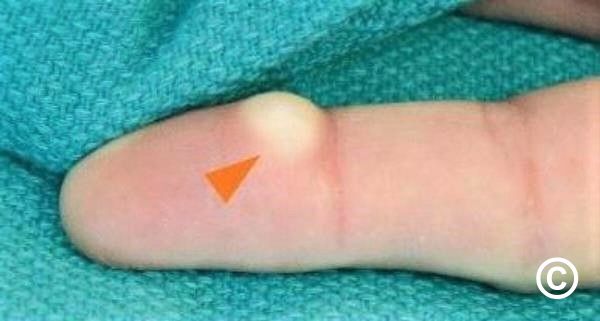 Inclusion Cysts Foot