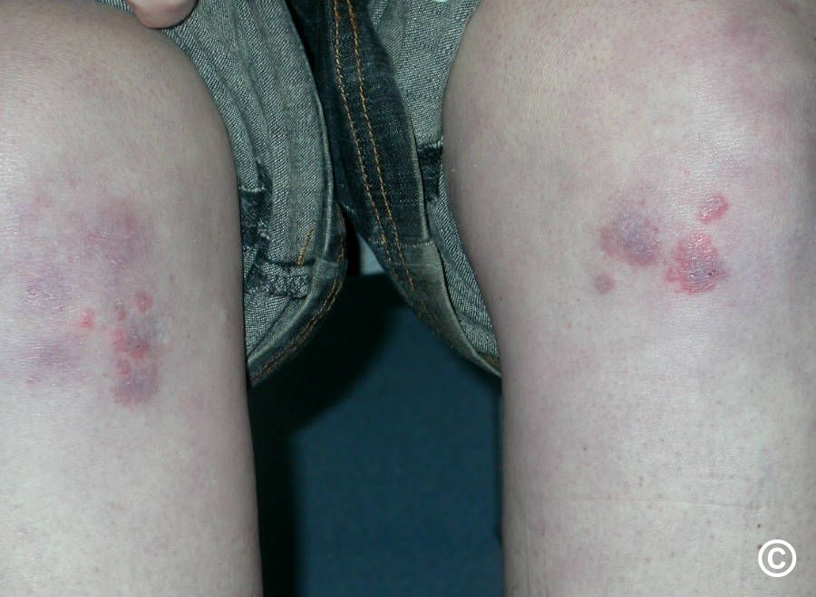 Erythema Elevatum Diutinum Pictures Erythema Elevatum Diutinum Bako
