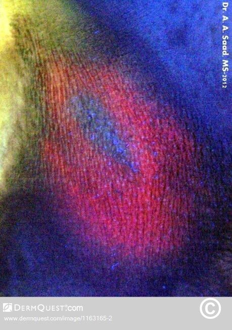 Erythrasma Woods Lamp I0DO Esthetician Portable Woods Lamp Skin