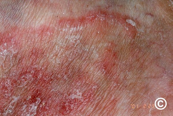 Erythrasma Groin