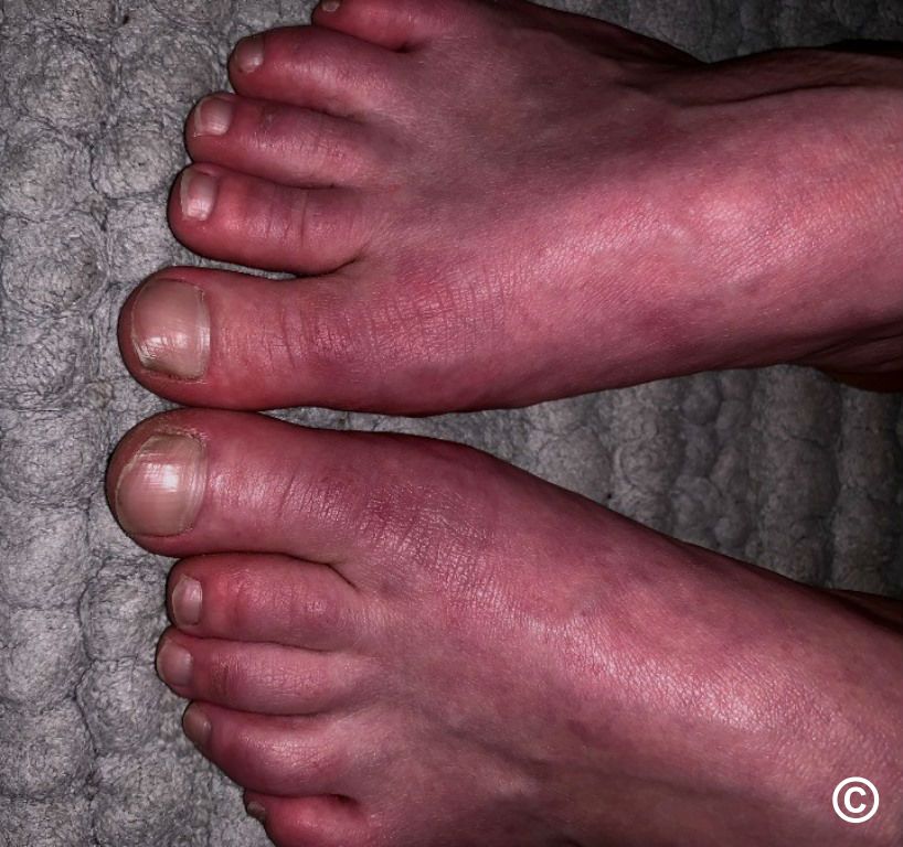Erythromelalgia