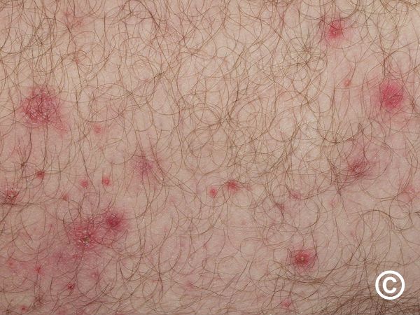 Folliculitis and furuncles / carbuncles (boils)