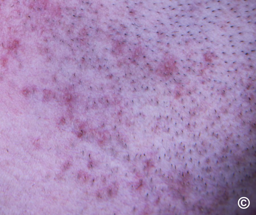 Folliculitis and furuncles / carbuncles (boils)