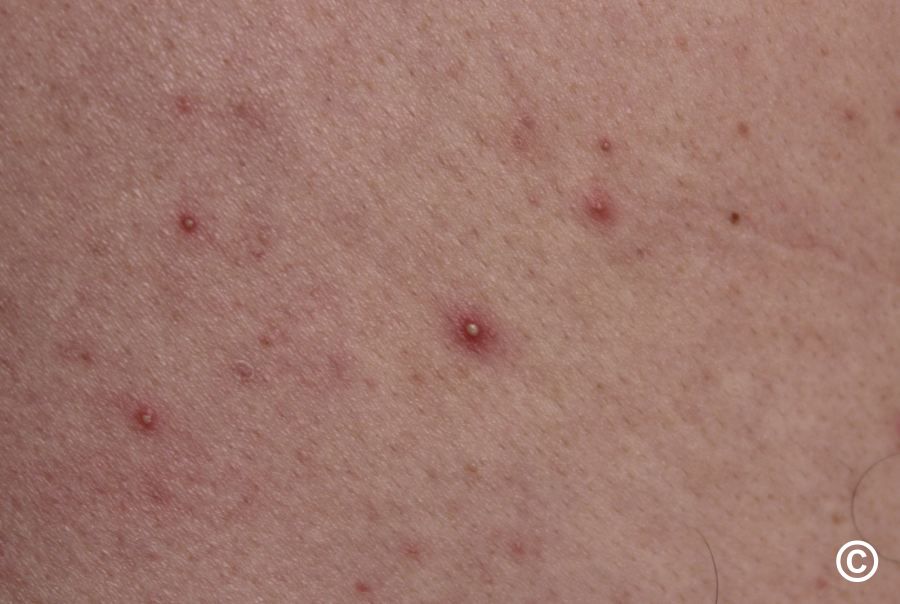 Pityrosporum Folliculitis Histology