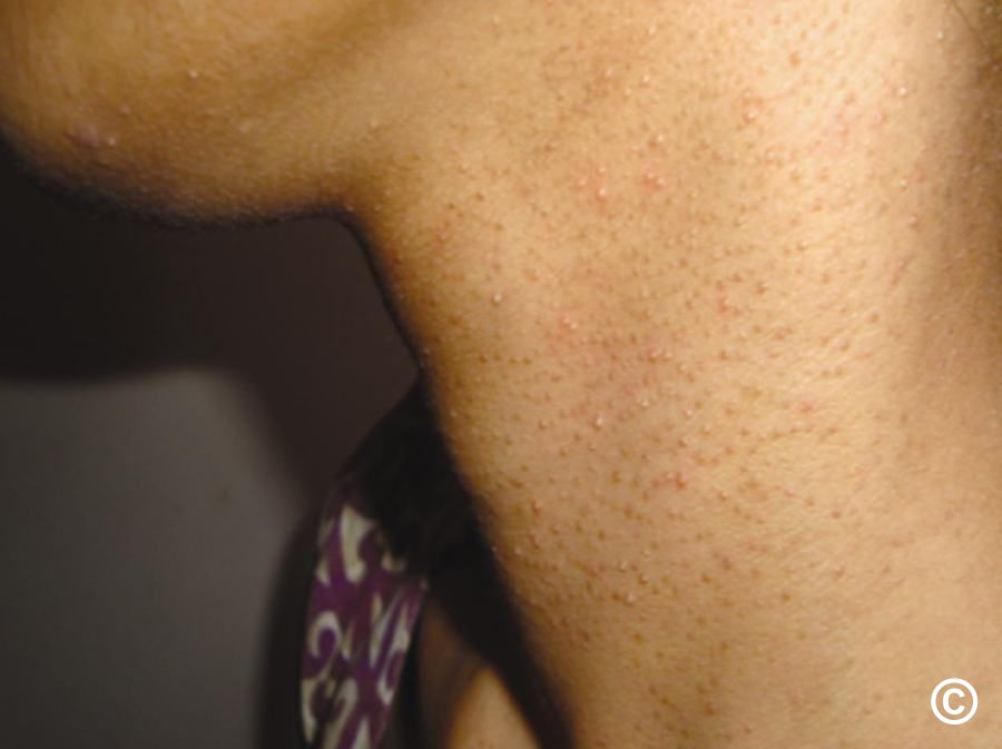 Fungal Folliculitis Neck