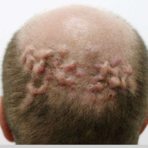 Dissecting Cellulitis