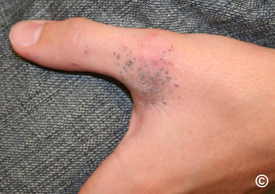 Foreign Body In The Skin