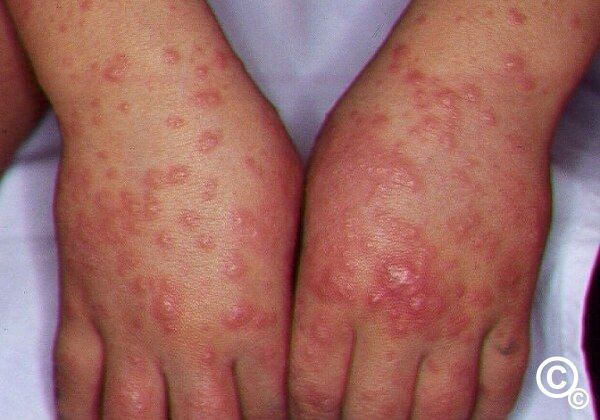 Histologia De Gianotti Crosti Gianotti Crosti Syndrome Of Atypical