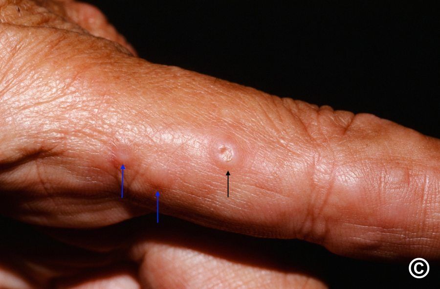 Granuloma Annulare Hands Ringed Eruption (Granuloma Annulare): Causes,