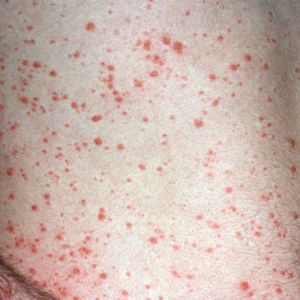 Guttate psoriasis