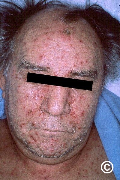 Shingles On Face Shingles (Zoster) Condition, Treatments And Pictures