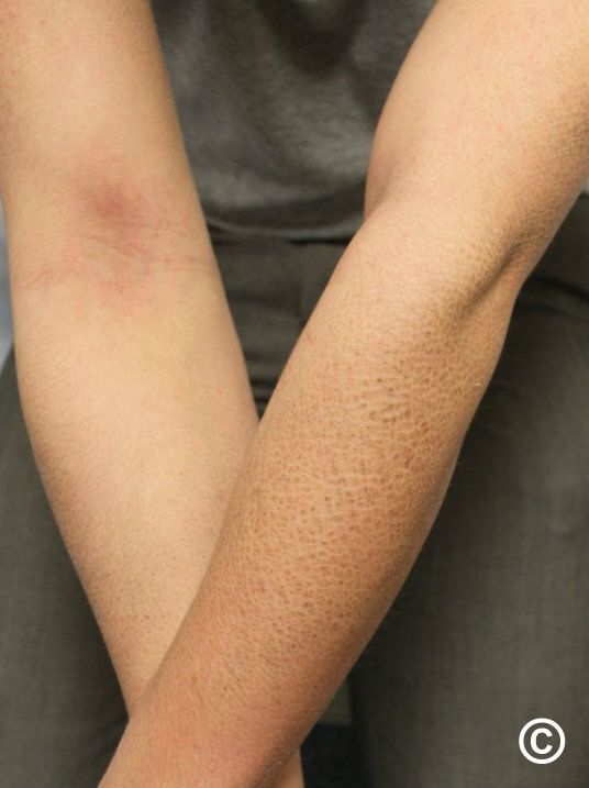 Mild Ichthyosis Vulgaris Autosomal Recessive Congenital Ichthyosis