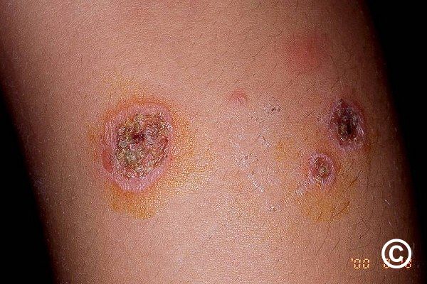 Impetigo On Legs A 5 Year Old Presents With "itchy Eczema"