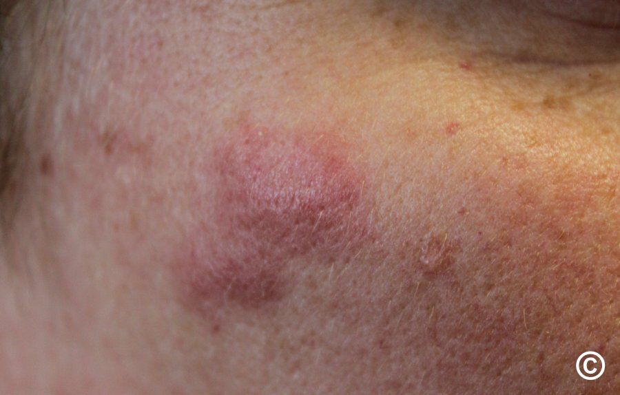 Infiltrado Linfocitico De Jessner Lupus Eritematoso Tumido En Lupus