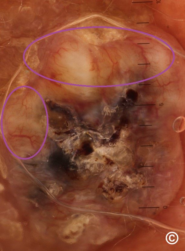 Keratoacanthoma