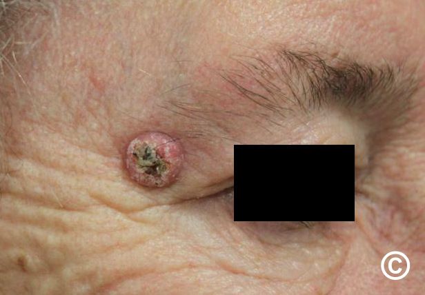 Keratoacanthoma