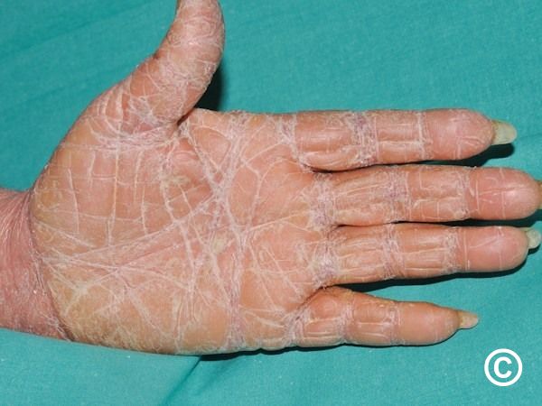 Keratoderma Climactericum