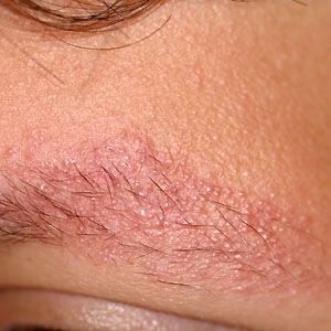 Keratosis Pilaris Rubra Faceii