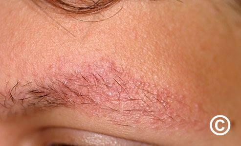 Keratosis Pilaris Atrophicans Faciei