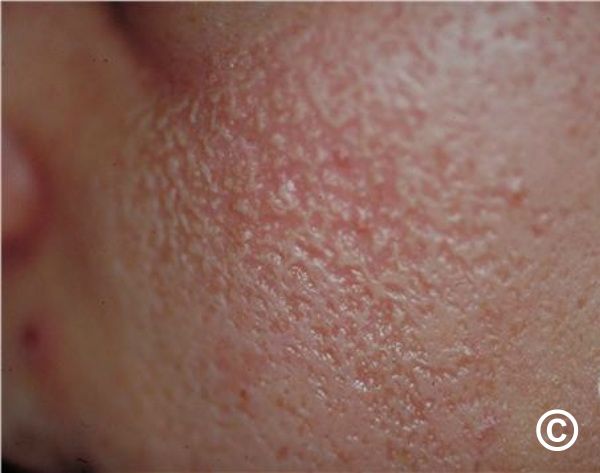 Follicular Atrophoderma Acral Folliculocentric Extragenital Lichen