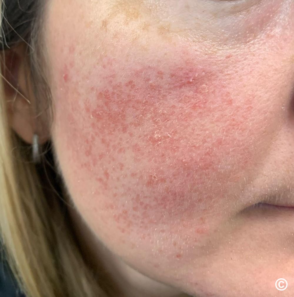 Keratosis Pilaris Atrophicans Faciei