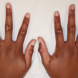 Bumps On Knuckles