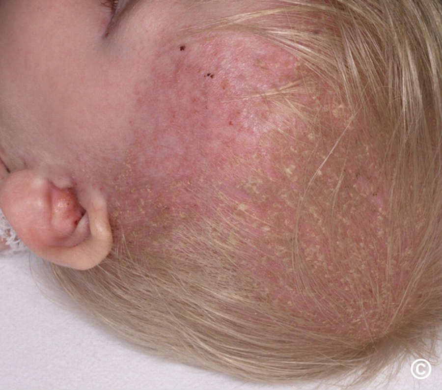 Langerhans Cell Histiocytosis Skin