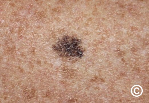 Lentigo