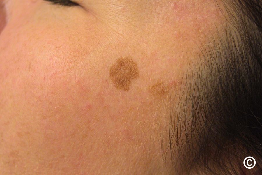 Solar Lentigo On Legs