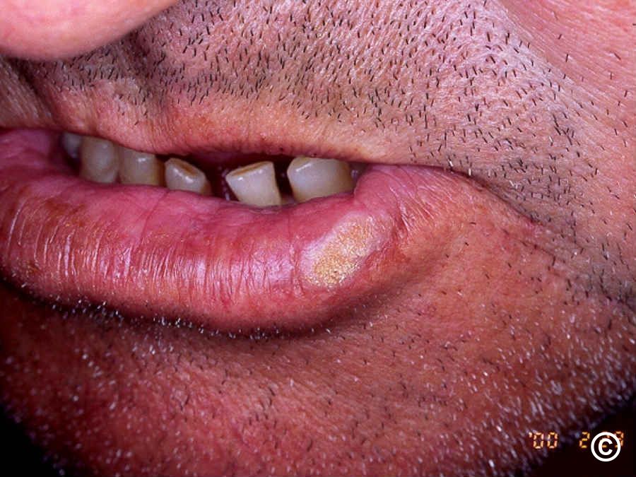 Leukoplakia Lip