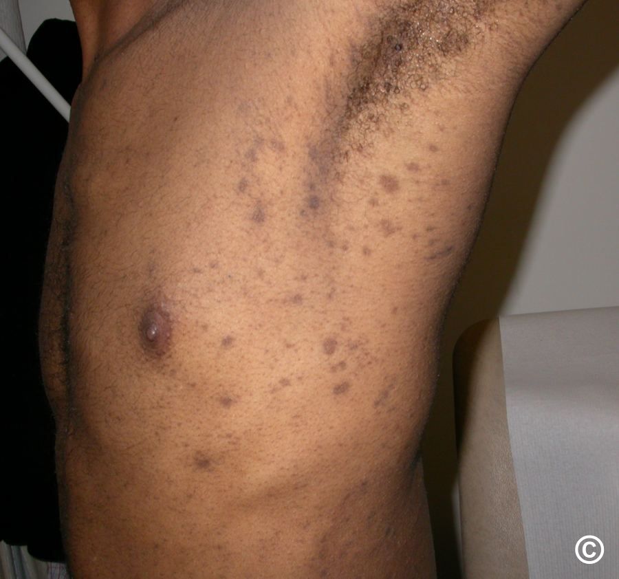 Lichen Planus Pigmentosus