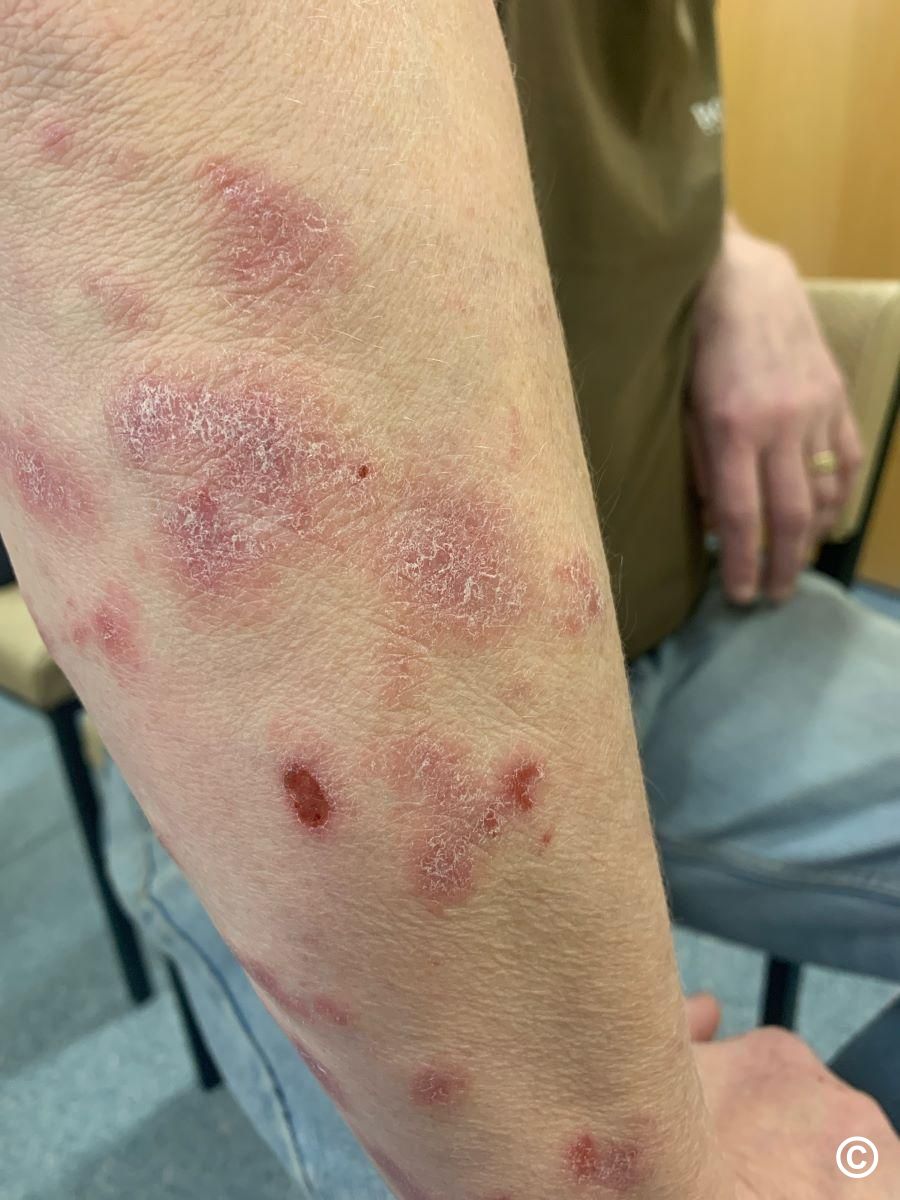 Lichen Planus Lesions