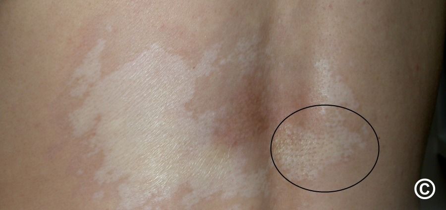 Lichen Sclerosus Et Atrophicus