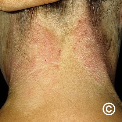 Lichen Simplex Chronicus Neck