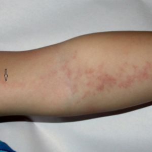 Lichen Striatus Face