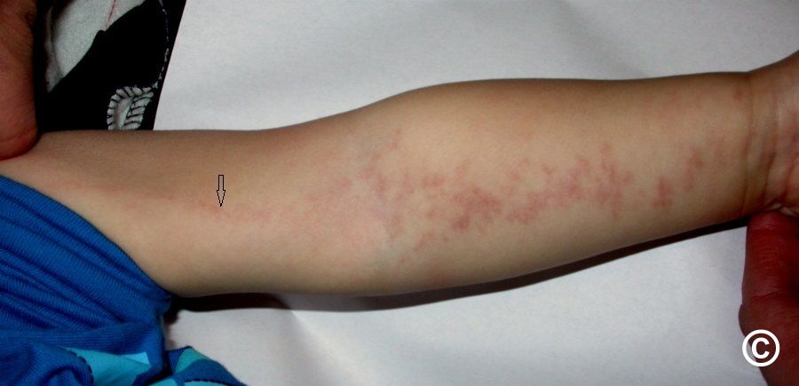 Linear Lichen Striatus Een Vrouw Met Een Streepvormige Huidafwijking