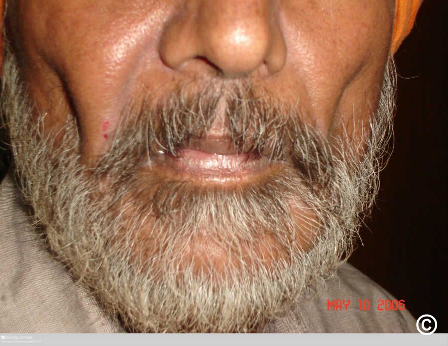 Lipoatrophy, lipodystrophy, and panatrophy