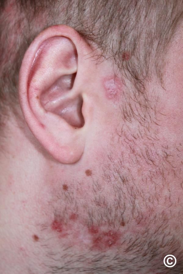 Lupus Scalp