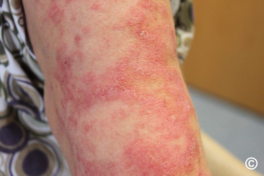 Lupus Rash On Upper Arms