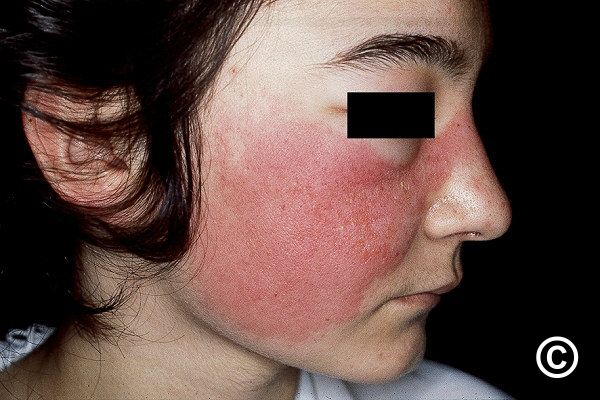 Rosacea Vs Lupus Butterfly Rash